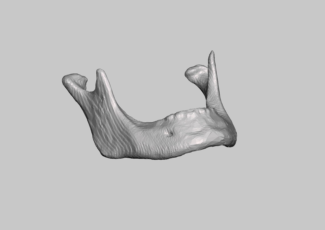 African American Male Skull and Jaw, AMAZINGLY Round (modern Human CT ...