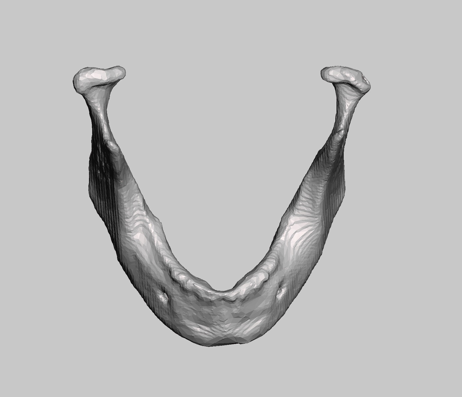 African American Male Skull and Jaw, AMAZINGLY Round (modern Human CT ...