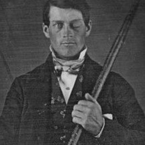 Phineas Gage Skull, (harvard CT SCAN), Museum Quality High Resolution ...