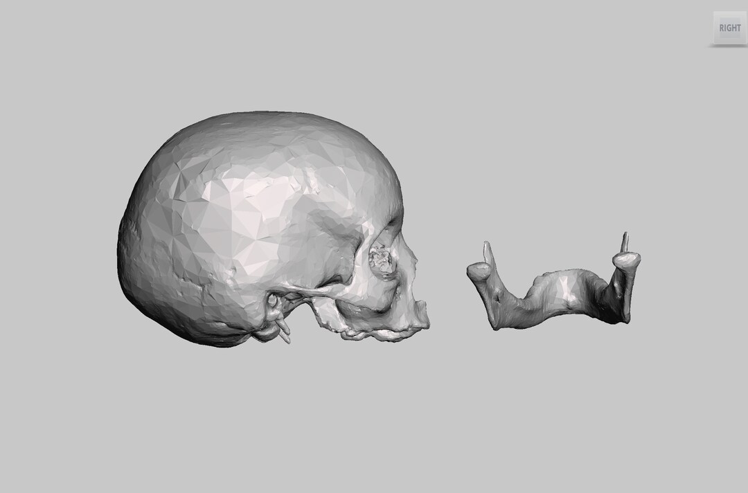 Female Undetermined Ancestry Skull, Unautopsied (modern Human CT SCAN ...
