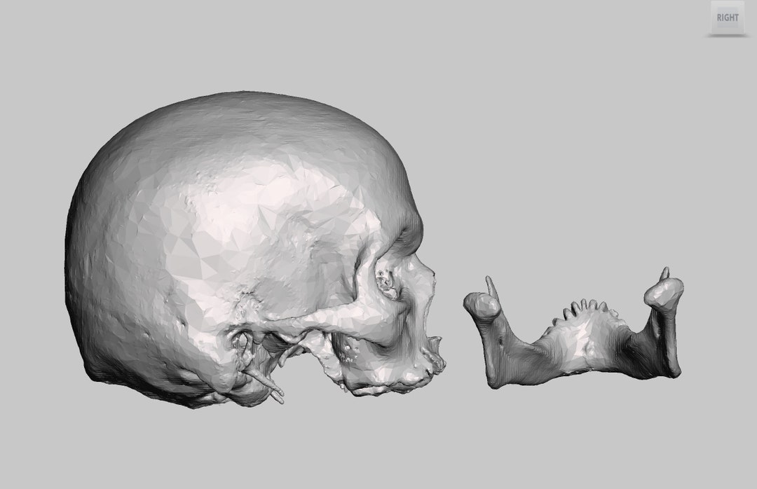 Male European Skull, Edentulous (toothless), Unautopsied Modern Human ...