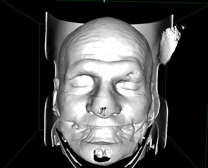 Unusual Male Skull, Edentulous (toothless), Quality High Resolution STL ...