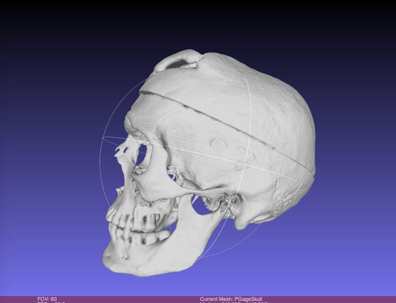 Phineas Gage Skull, harvard CT SCAN, Museum Quality High Resolution STL ...