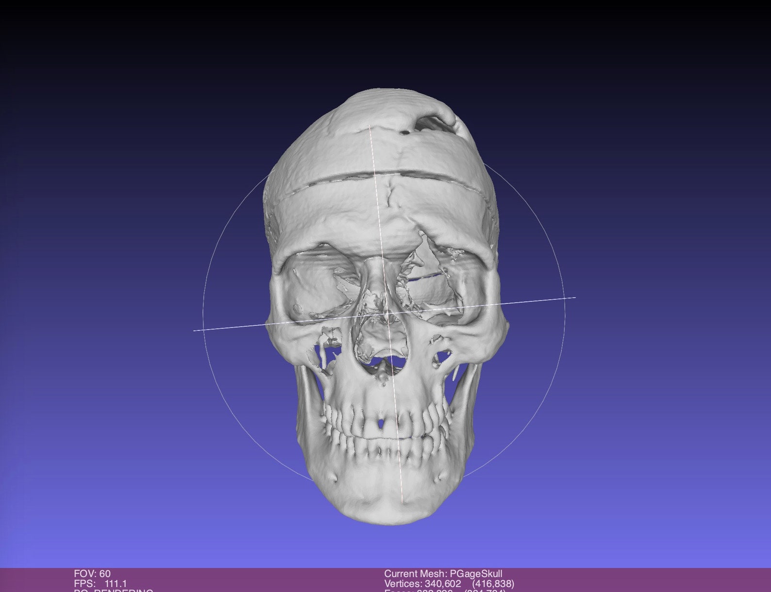 Phineas Gage Skull, (harvard CT SCAN), Museum Quality High Resolution ...