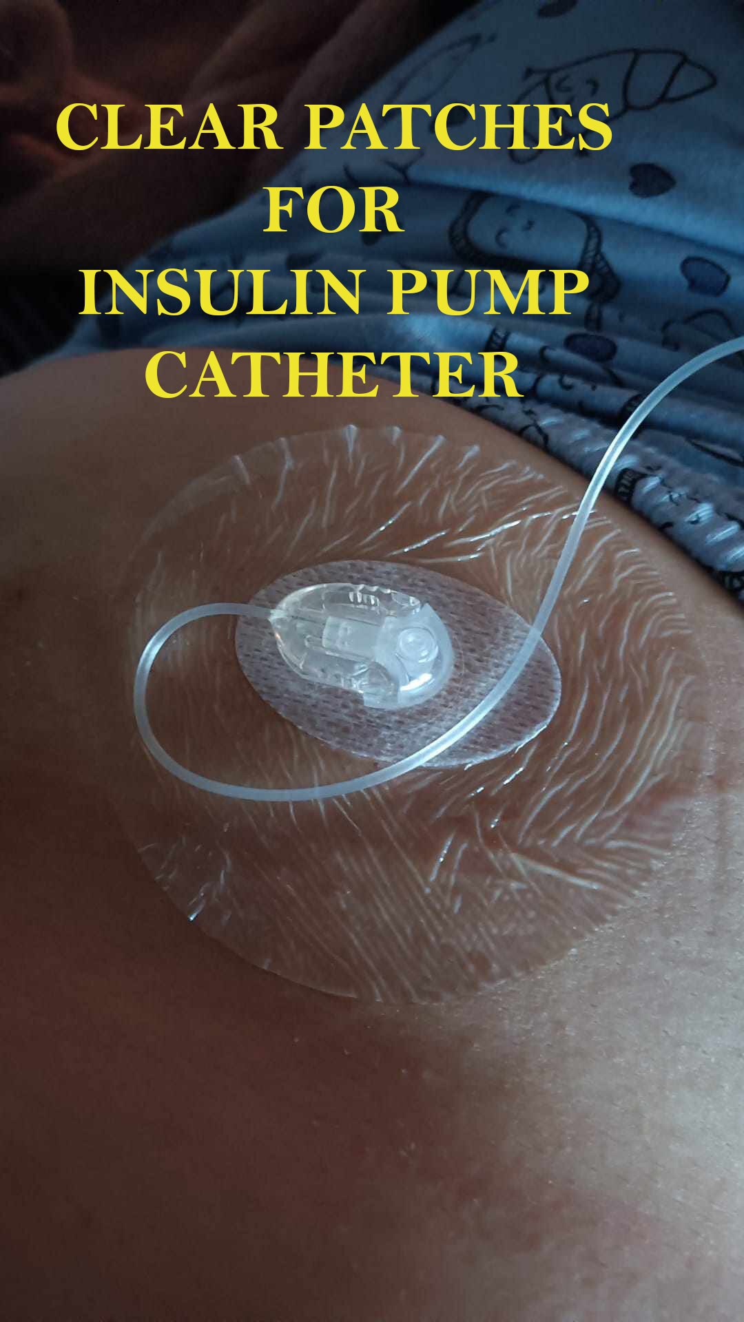 Insulin Pumps Clear Transparent Patches Adhesives - Etsy