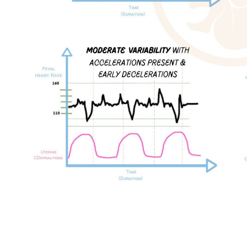 Fetal Heart Rate Monitoring: Variability - Etsy Fetal Heart Rate Monitoring: Variability - Etsy