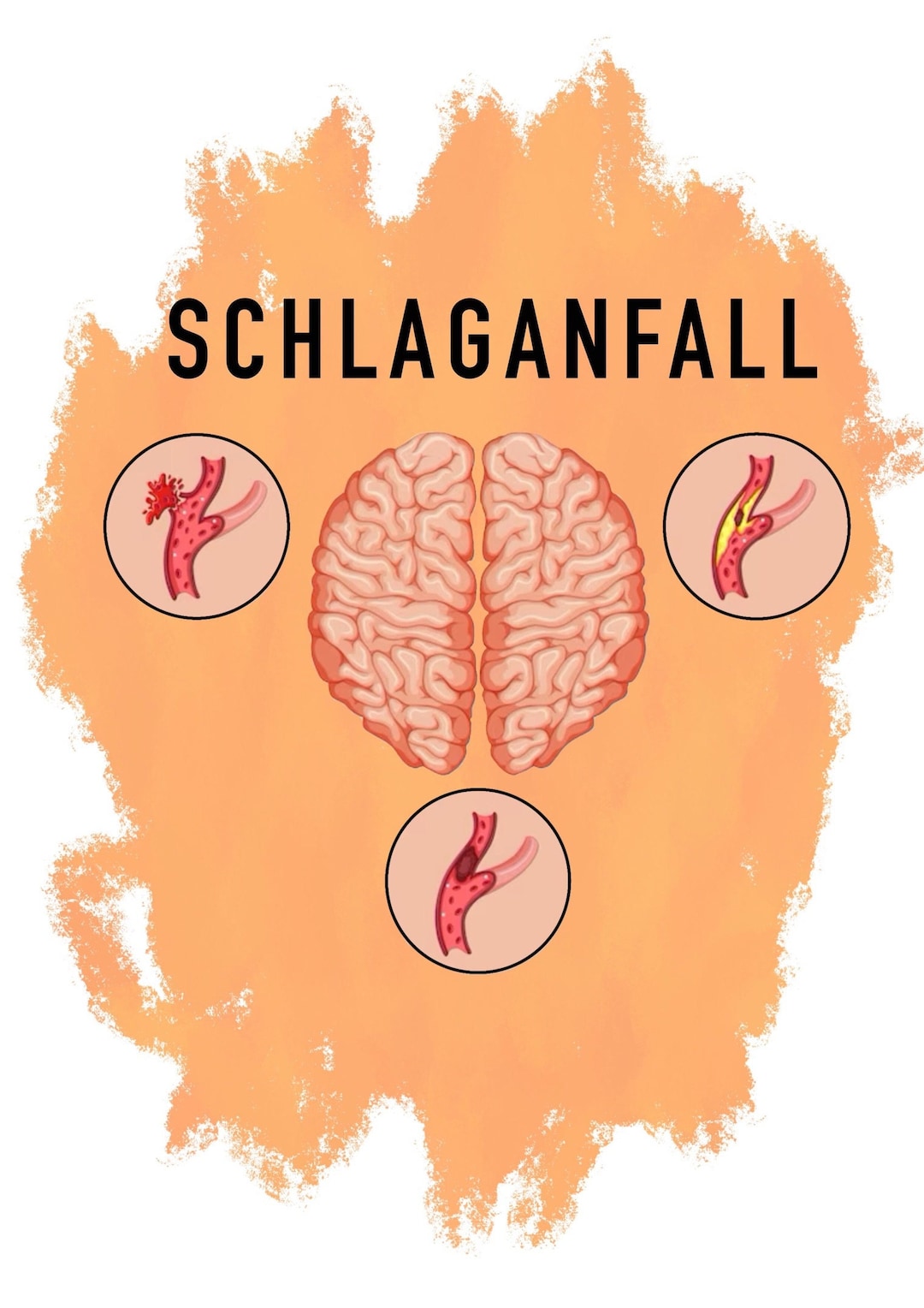 Lernzettel Schlaganfall - Etsy.de