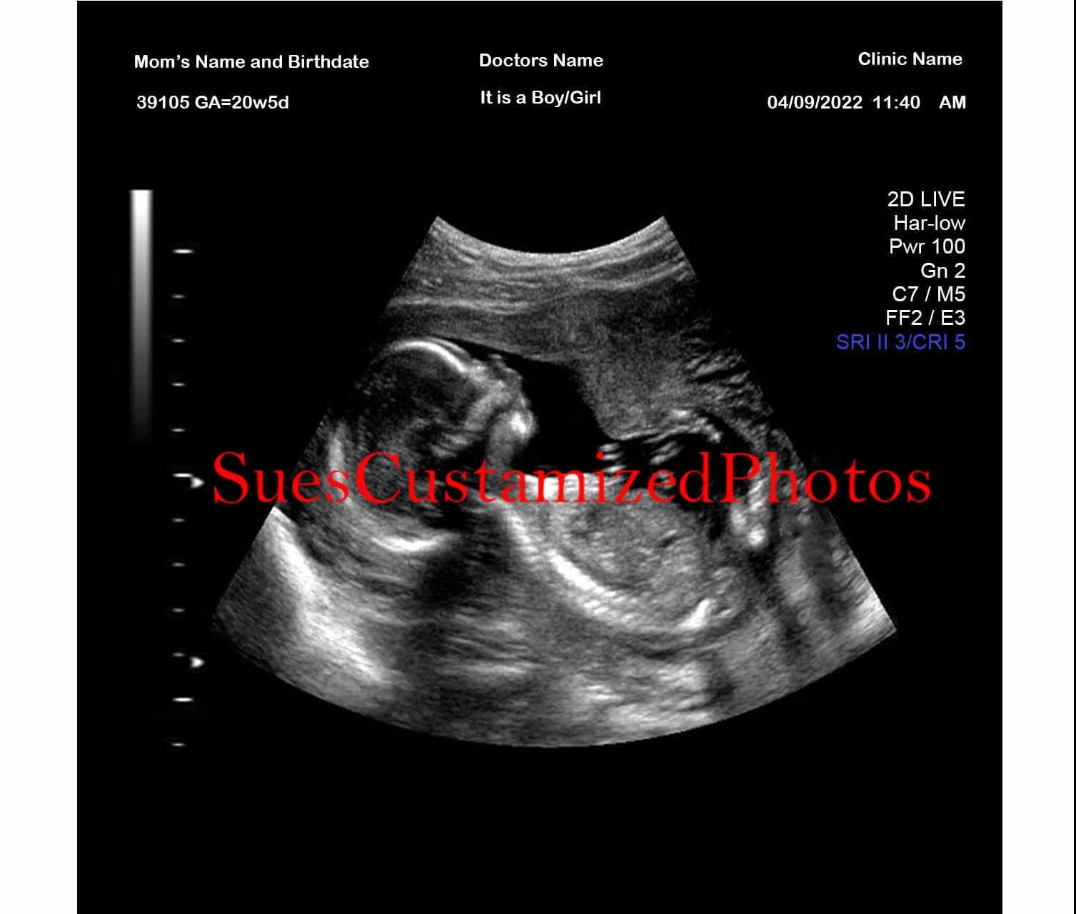 20 Weeks Ultrasound Girl