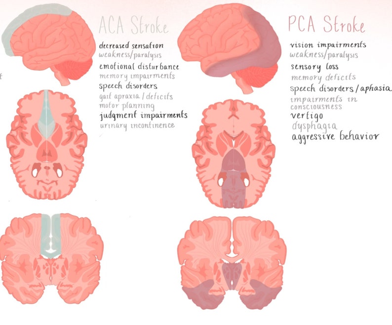 Stroke Symptom and Anatomy Educational Handout - Etsy