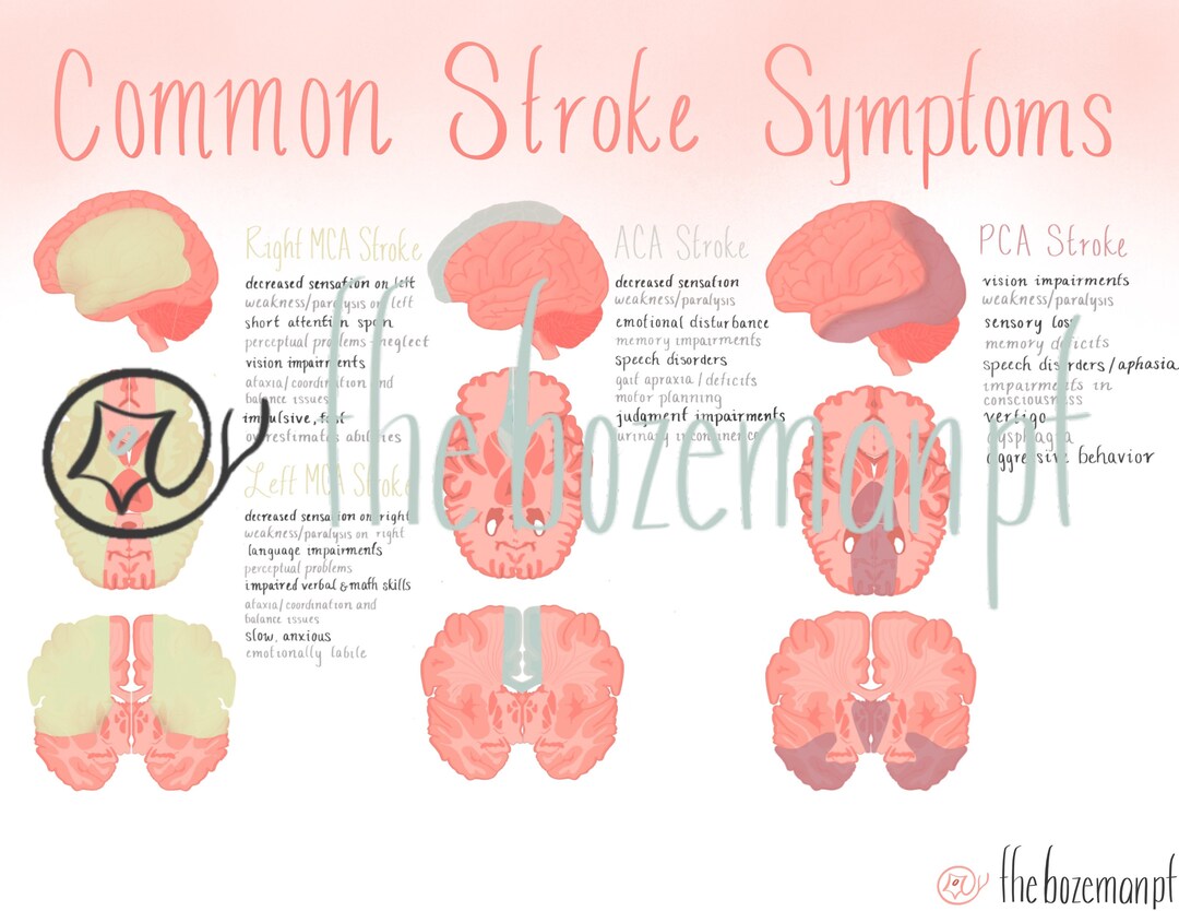 Stroke Symptom and Anatomy Educational Handout - Etsy