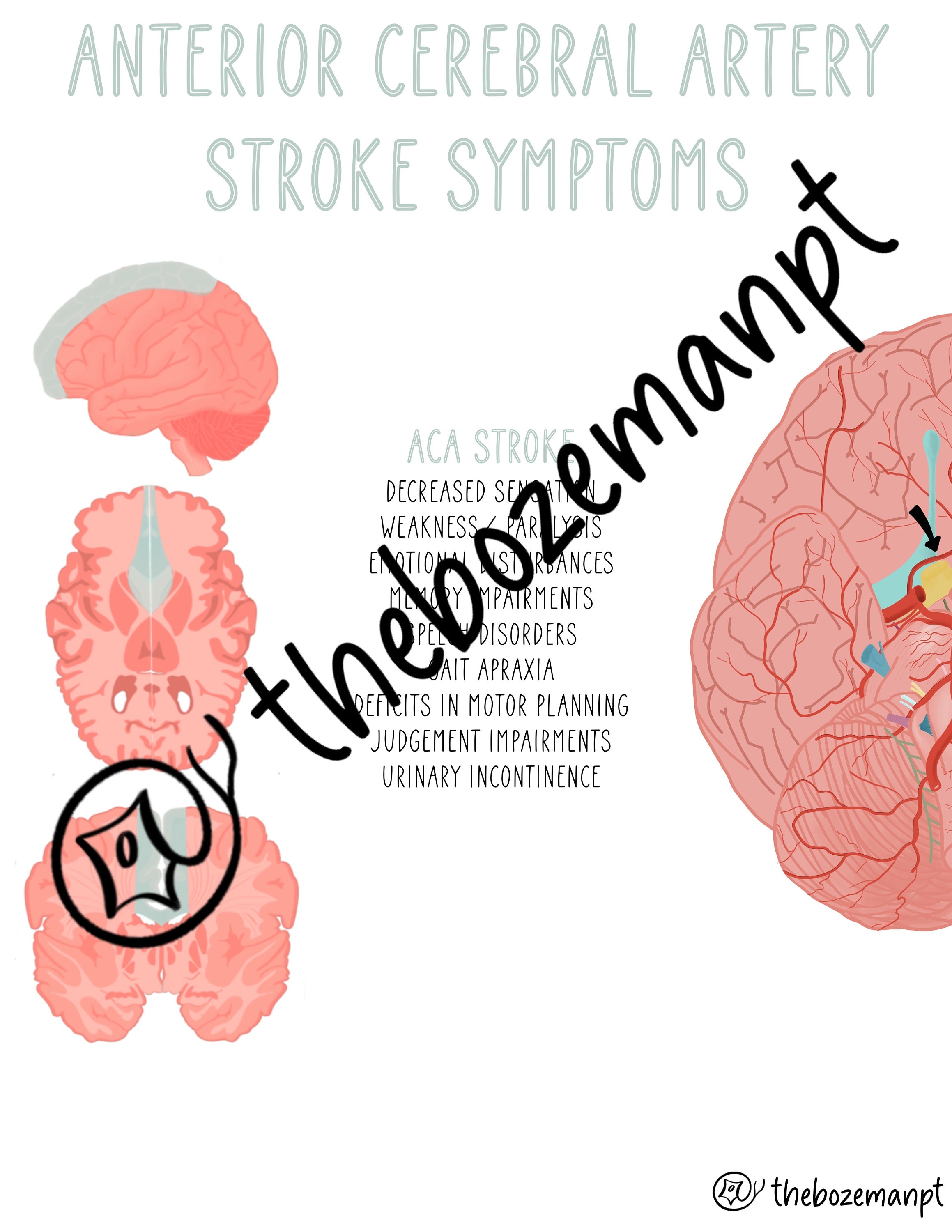 Stroke Symptom and Anatomy Educational Handout - Etsy