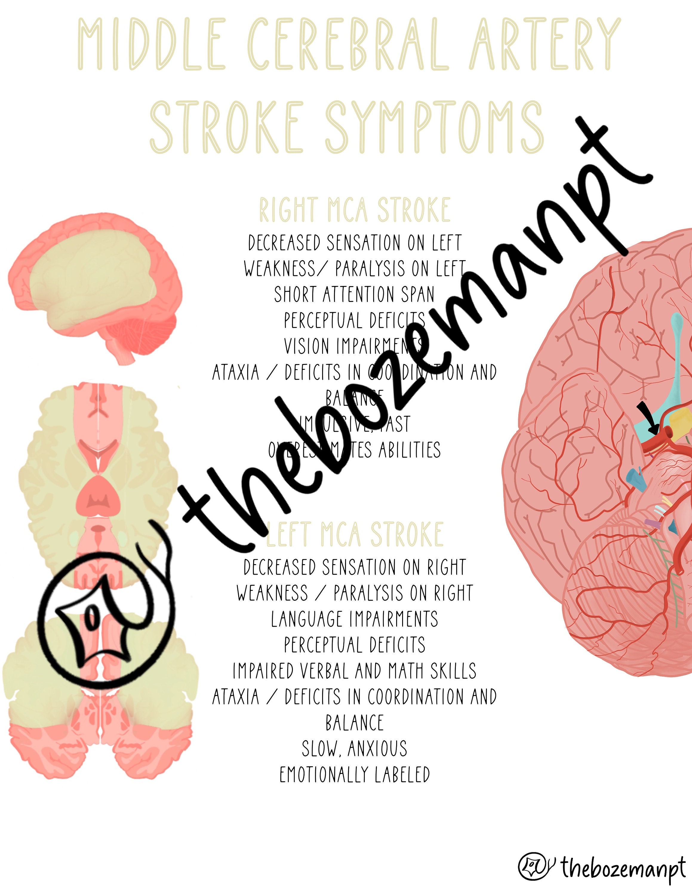 Stroke Symptom and Anatomy Educational Handout - Etsy