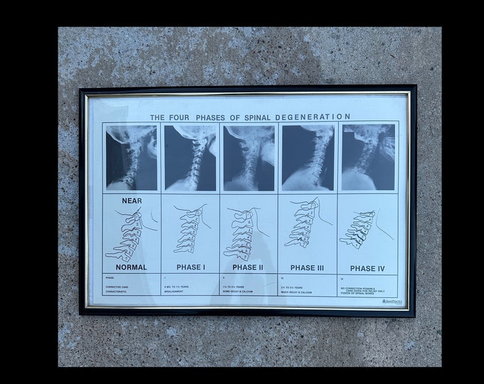 Vintage Spinal Poster in Frame / Spinal Degeneration / Educational ...