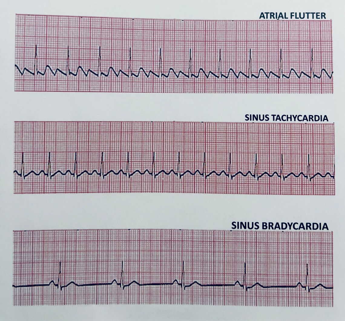 New 2025 EKG Exam | Instant Download | EKG Study Guide | EKG | Nursing ...