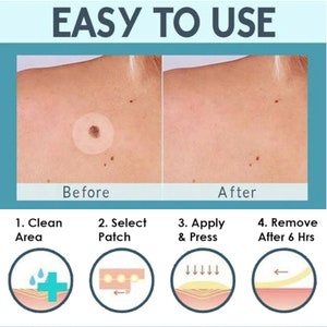 New Skin Tag Remover Patches High Quality Treatment for Moles Warts ...