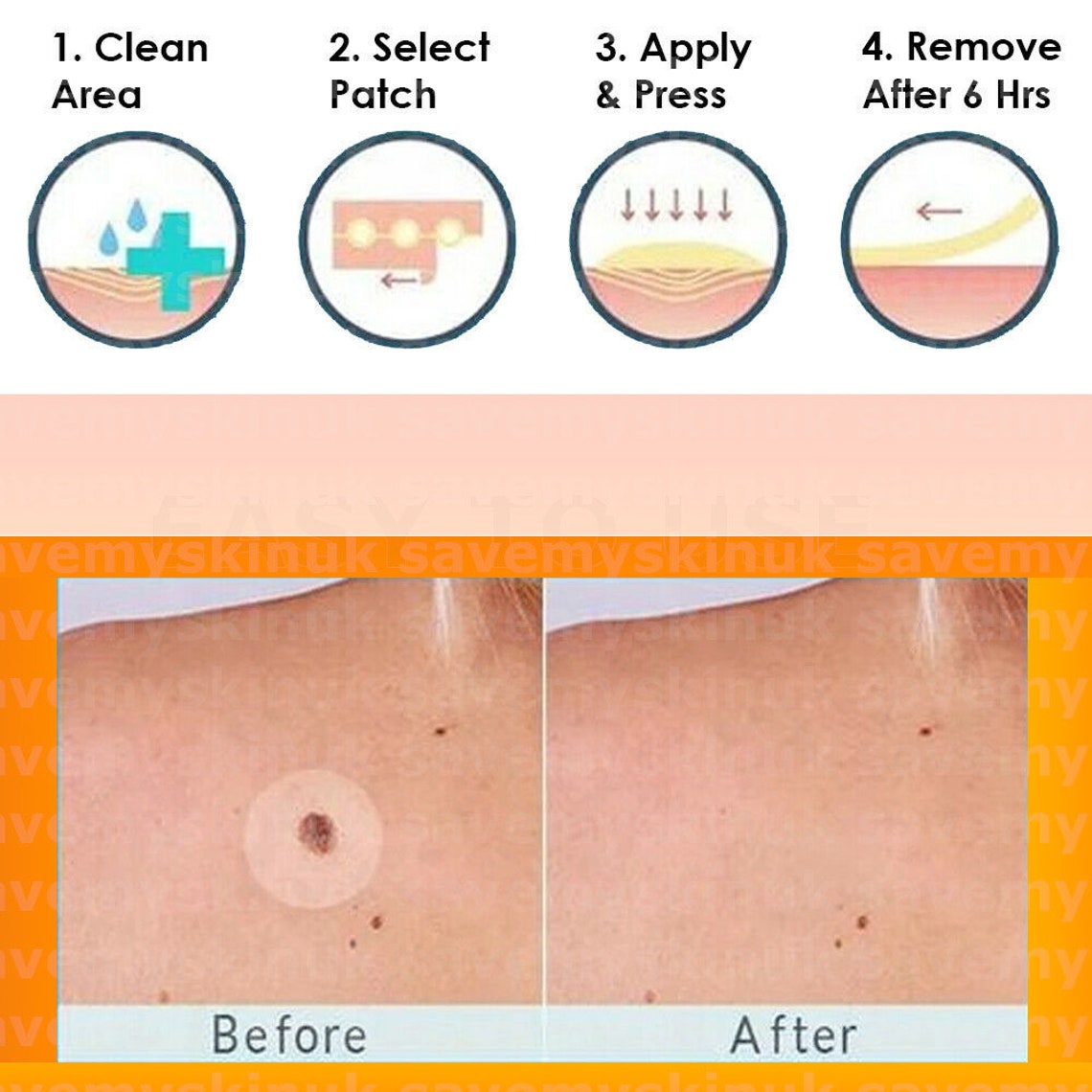 New Skin Tag Remover Patches High Quality Treatment for Moles Warts ...