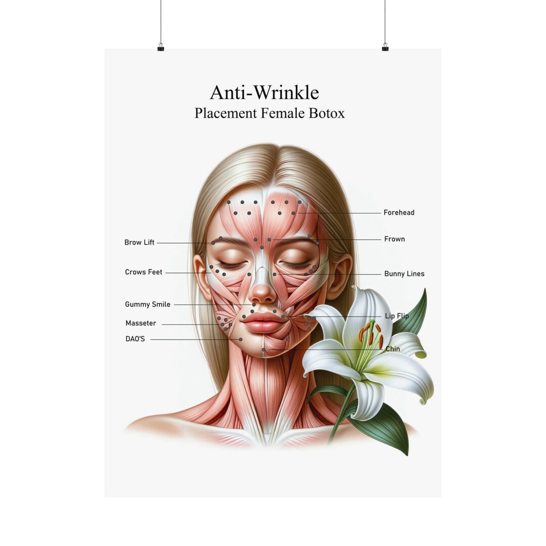 Anti-wrinkle Botox Treatment Area Poster, Med Spa Decor - Etsy