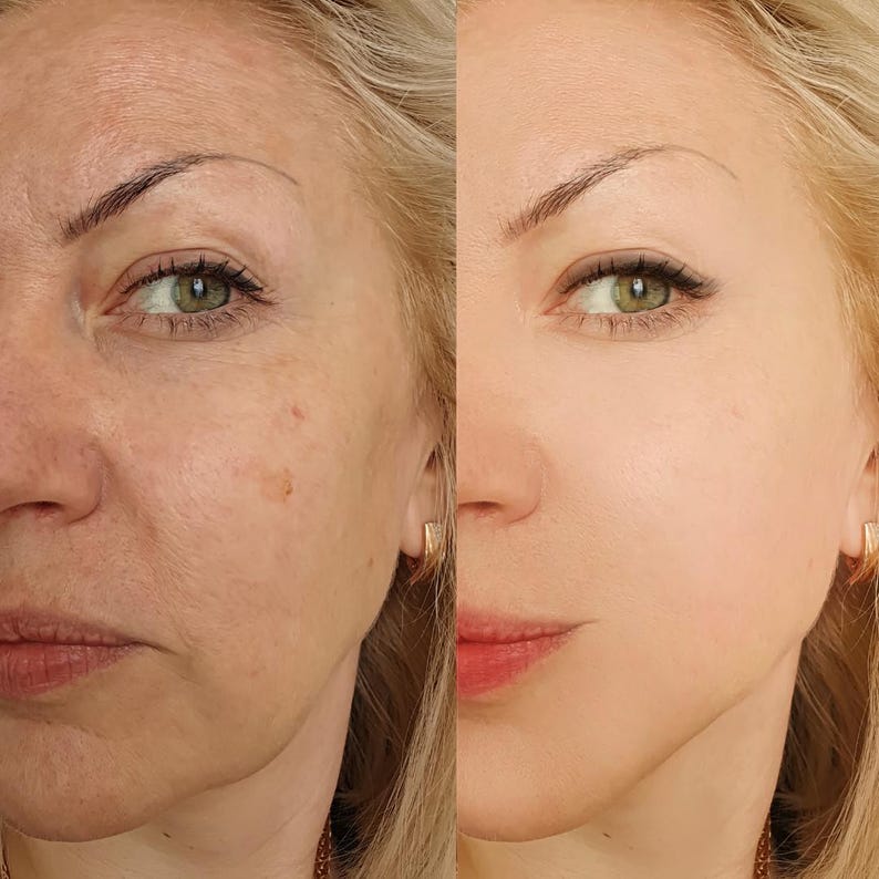 Intense Pulsed Light Facial and Neck Massager - Wrinkles Reducing ...