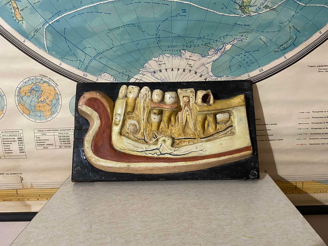 Vintage Anatomy Model of Human Jaw, Teeth. Tooth Decay. - Etsy