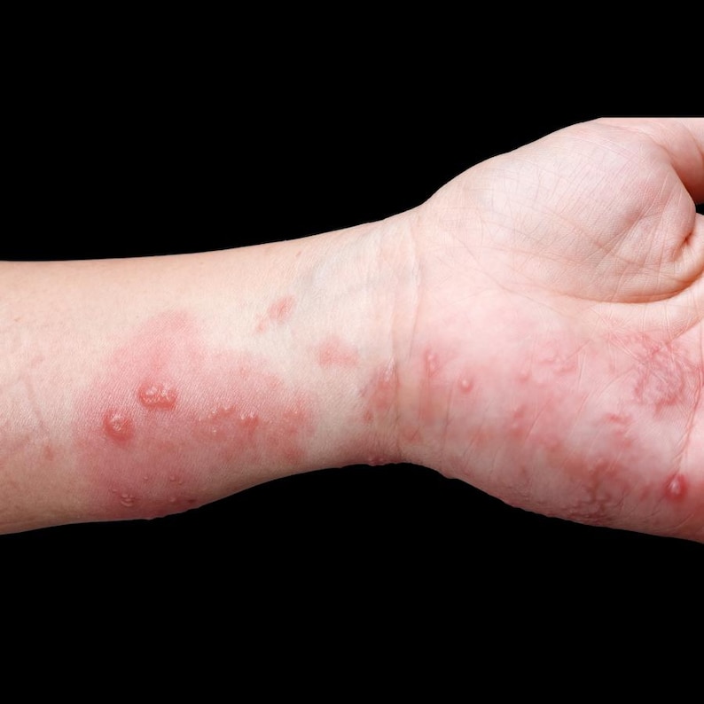 Dermatology Rash/lesion EASY Description Chart for Nurses, Pas, Nps ...