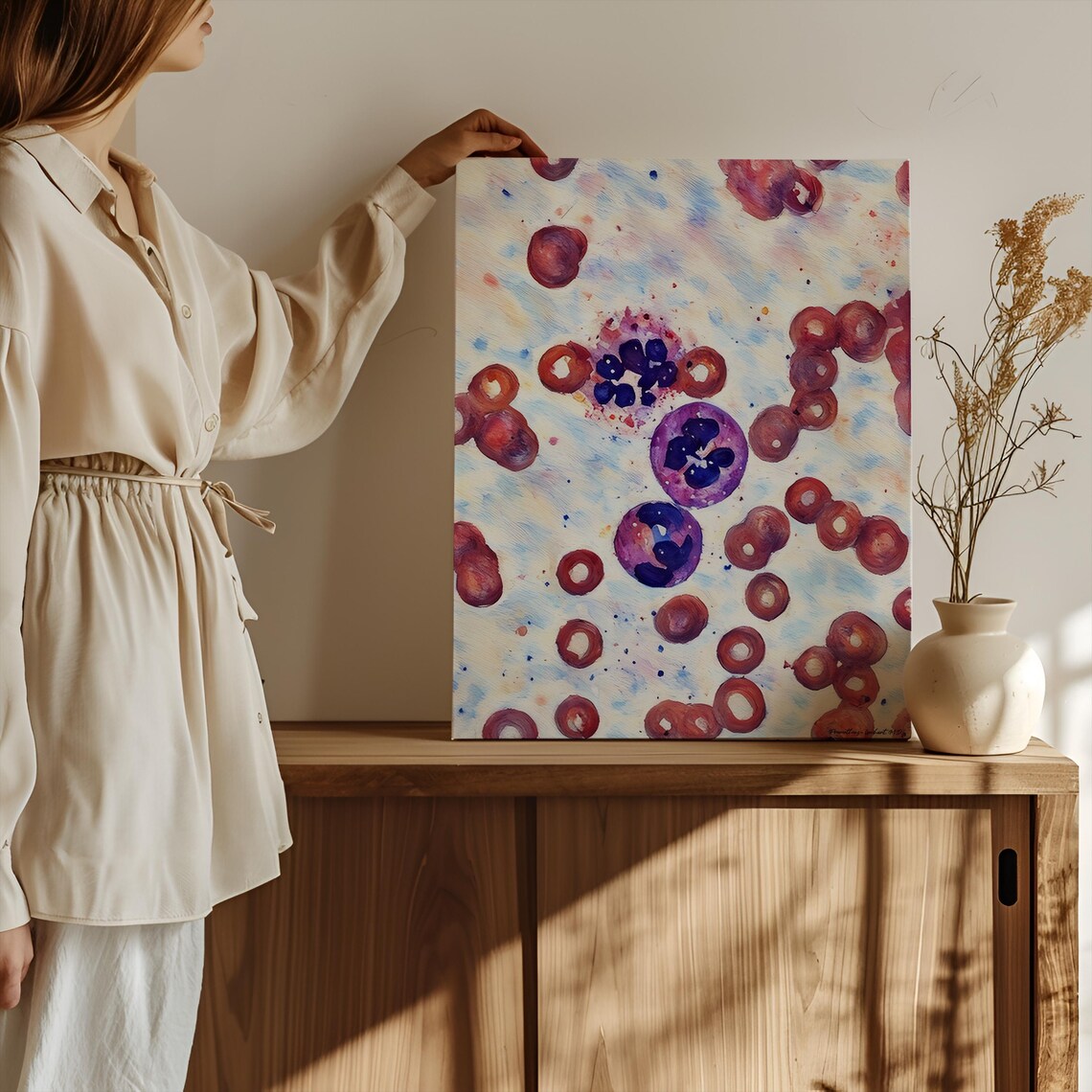 Megaloblastic Anemia Art Canvas, Poster, or Acrylic Glass. Bone Marrow ...
