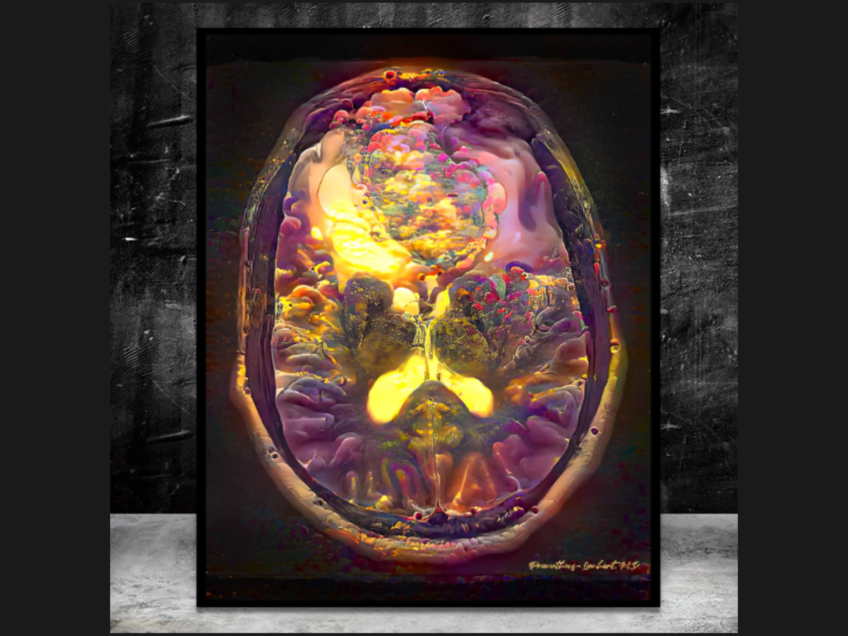 Brain Anatomy Brain Tumor Ready to Hang Canvas Radiology - Etsy