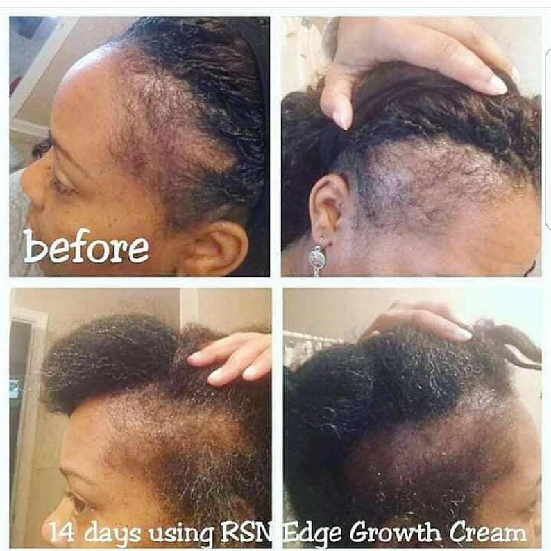 Edge Growth Cream Regrow Hair Hair Loss Cream - Etsy