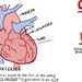 Coronary Artery Disease (CAD) - Etsy