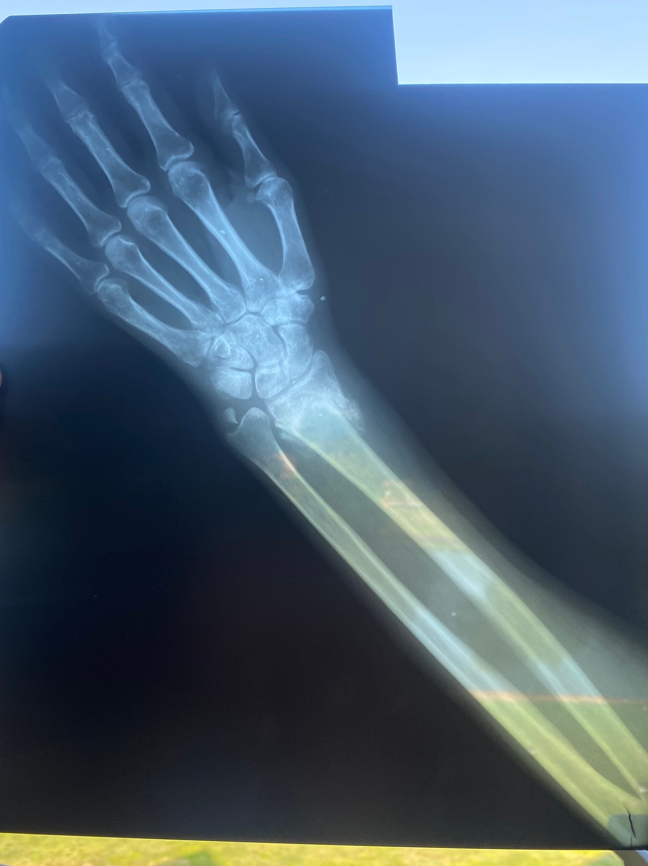 Vintage X-ray Human Hand and Forearm - Etsy