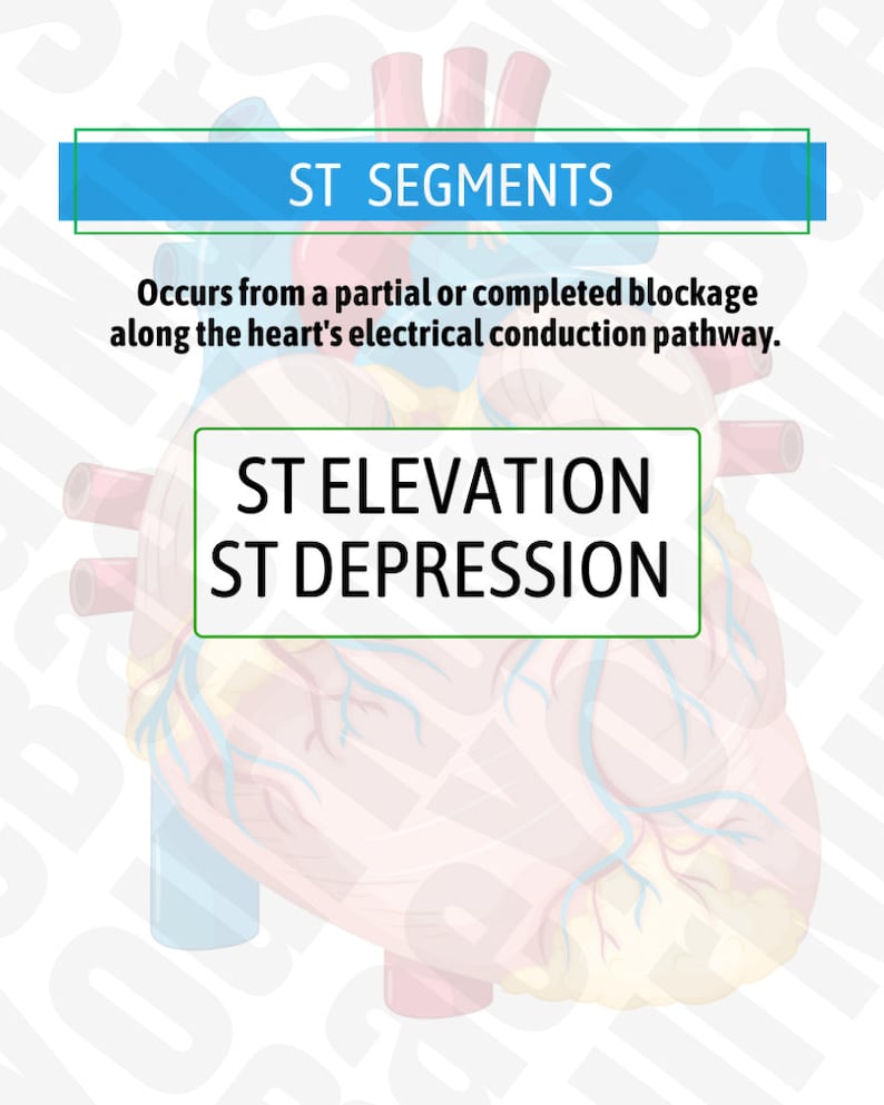 EKG Study Guide: Nursing Students, BLS/ACLS Rhythms, Careplans (45-page) - Etsy