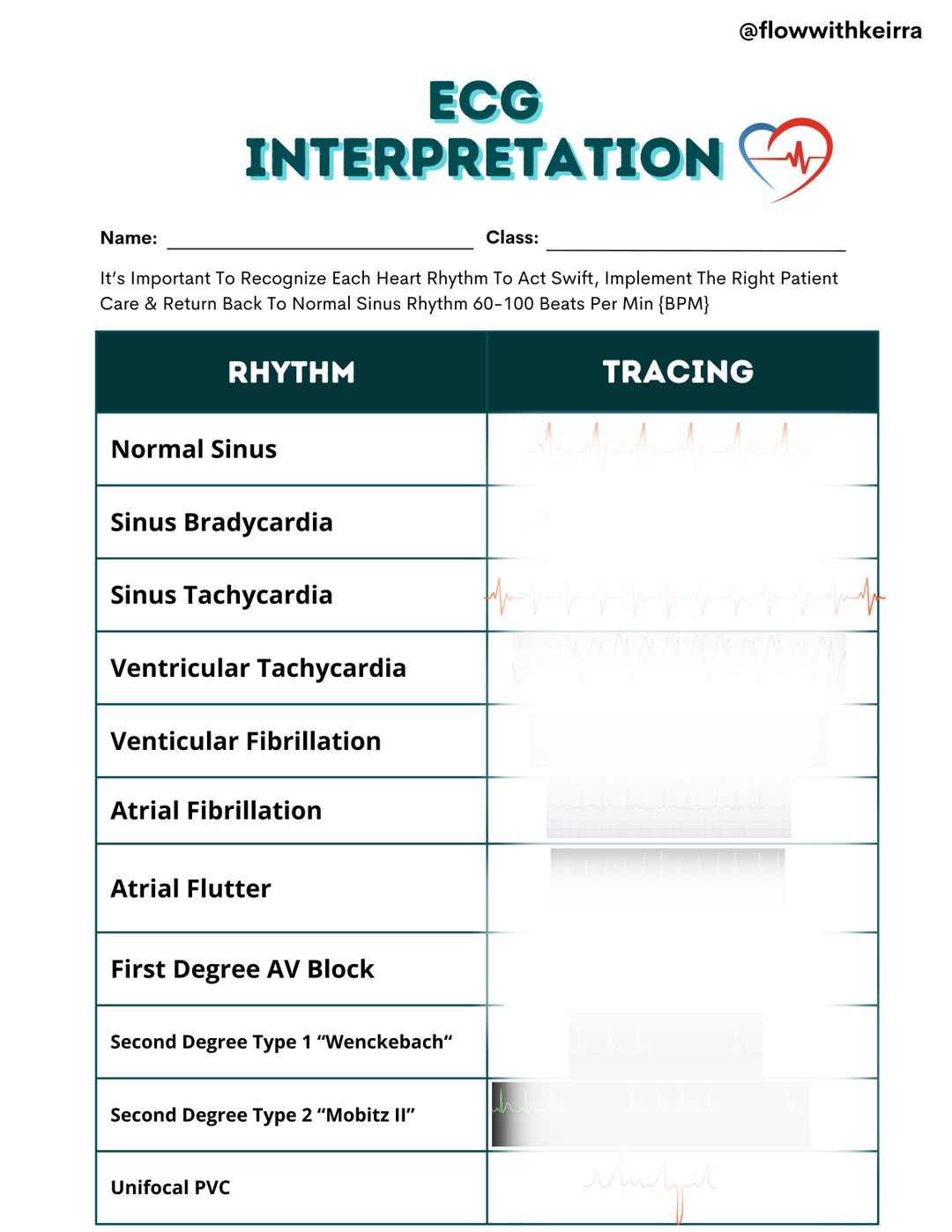 ECG Interpretation Cheat Sheet - Etsy ECG Interpretation Cheat Sheet - Etsy