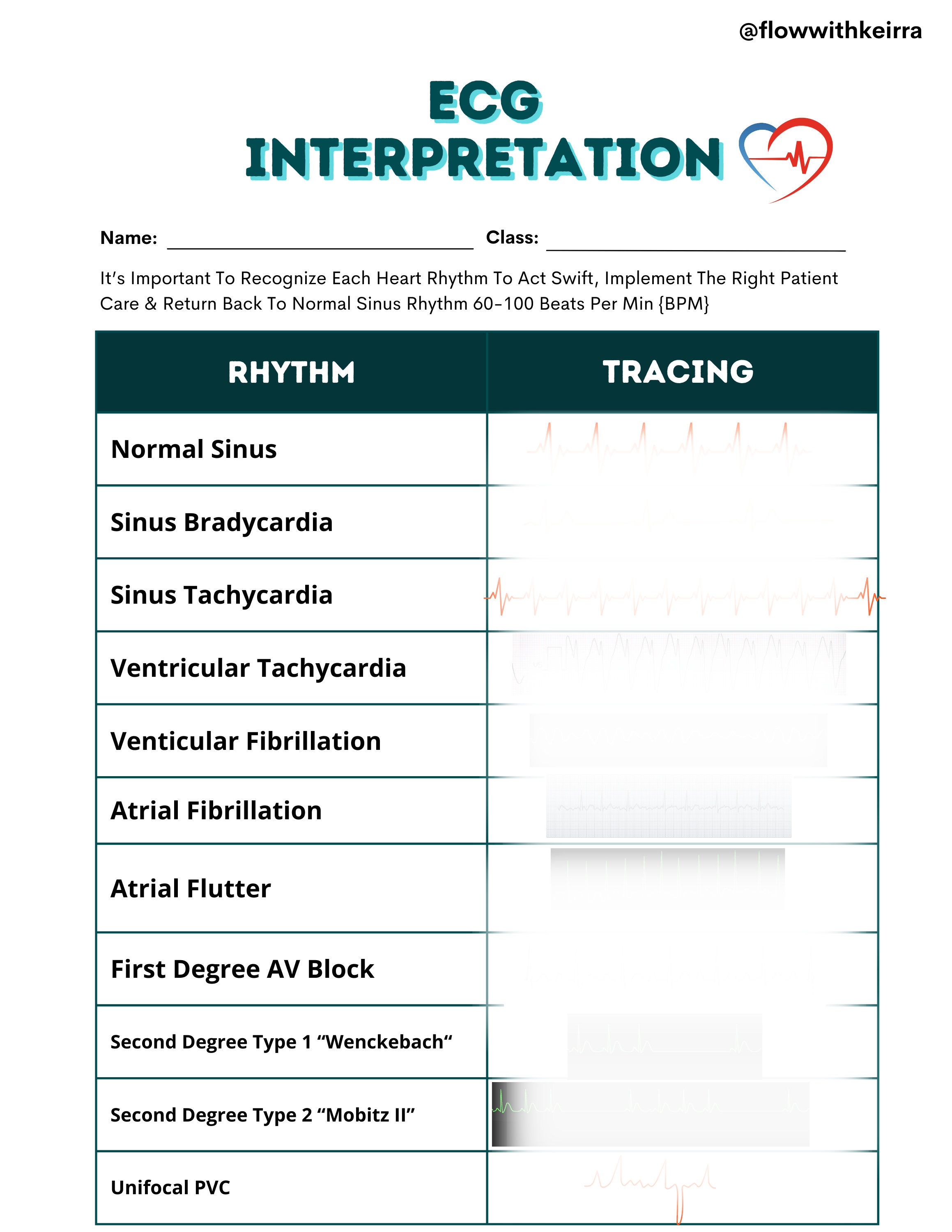 ECG Interpretation Cheat Sheet - Etsy ECG Interpretation Cheat Sheet - Etsy