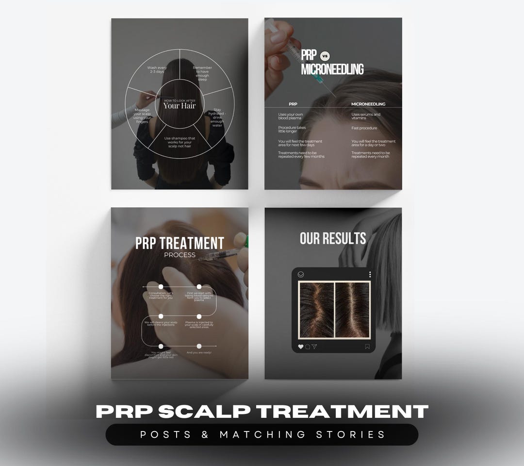 PRP Scalp Treatment Instagram Templates: Hair Loss Posts and Stories ...