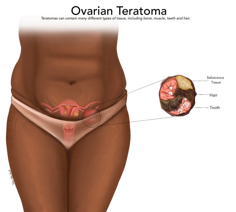 Teratoma Medical Illustration Anatomy Of A Teratoma Ob Gyn Art Downloadable File Etsy