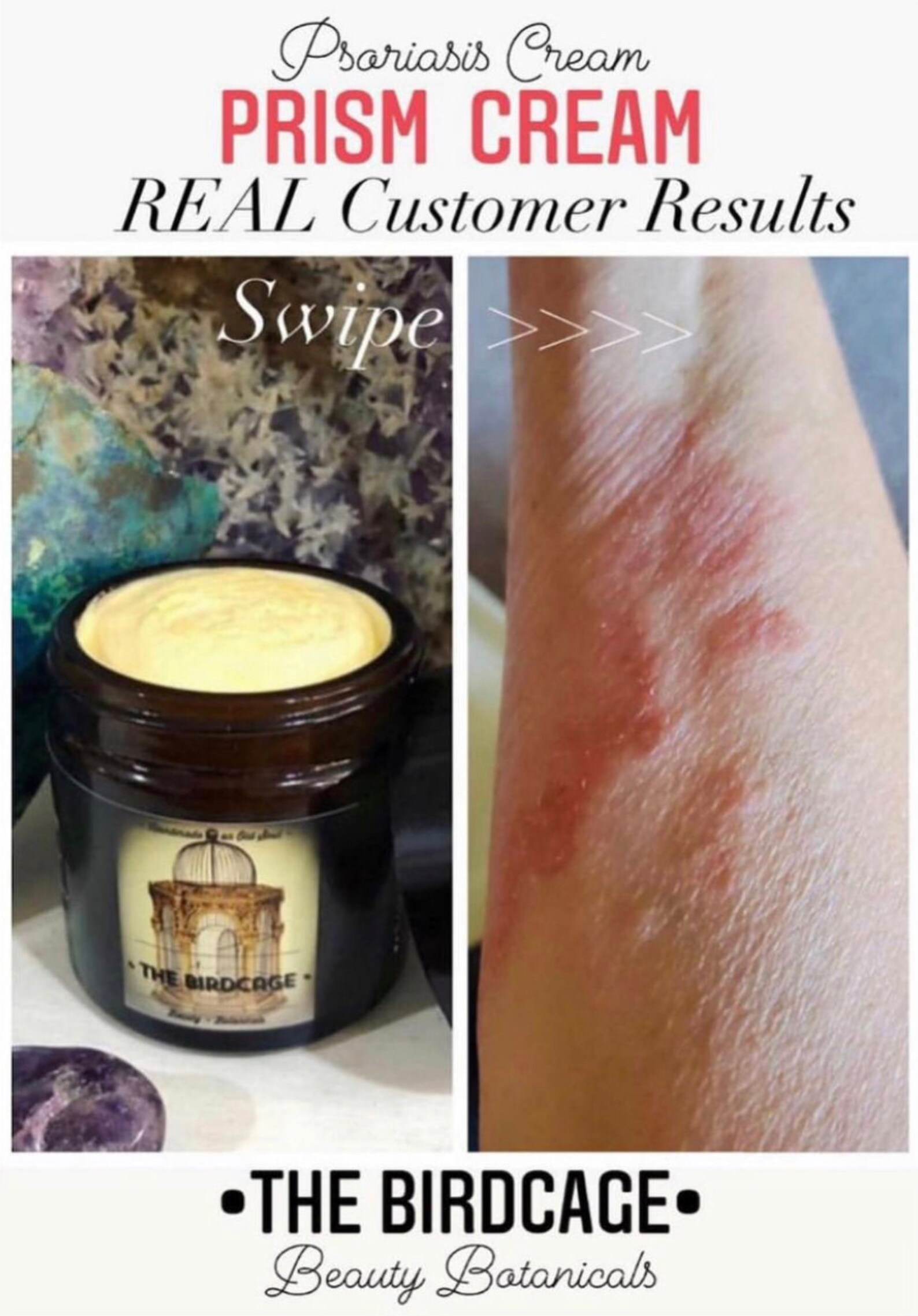 Prism Cream Psoriasis Cream Formulation Safe for All Skin Types Cooling ...