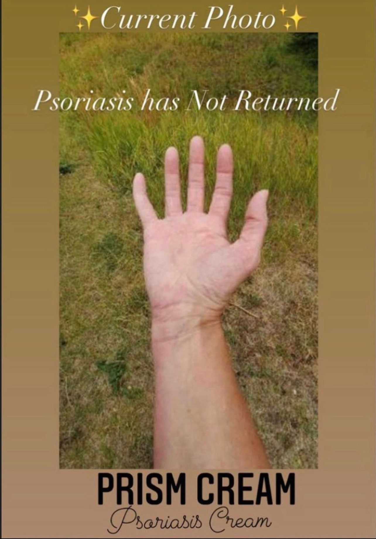 Prism Cream Psoriasis Cream Formulation Safe for All Skin Types Cooling ...