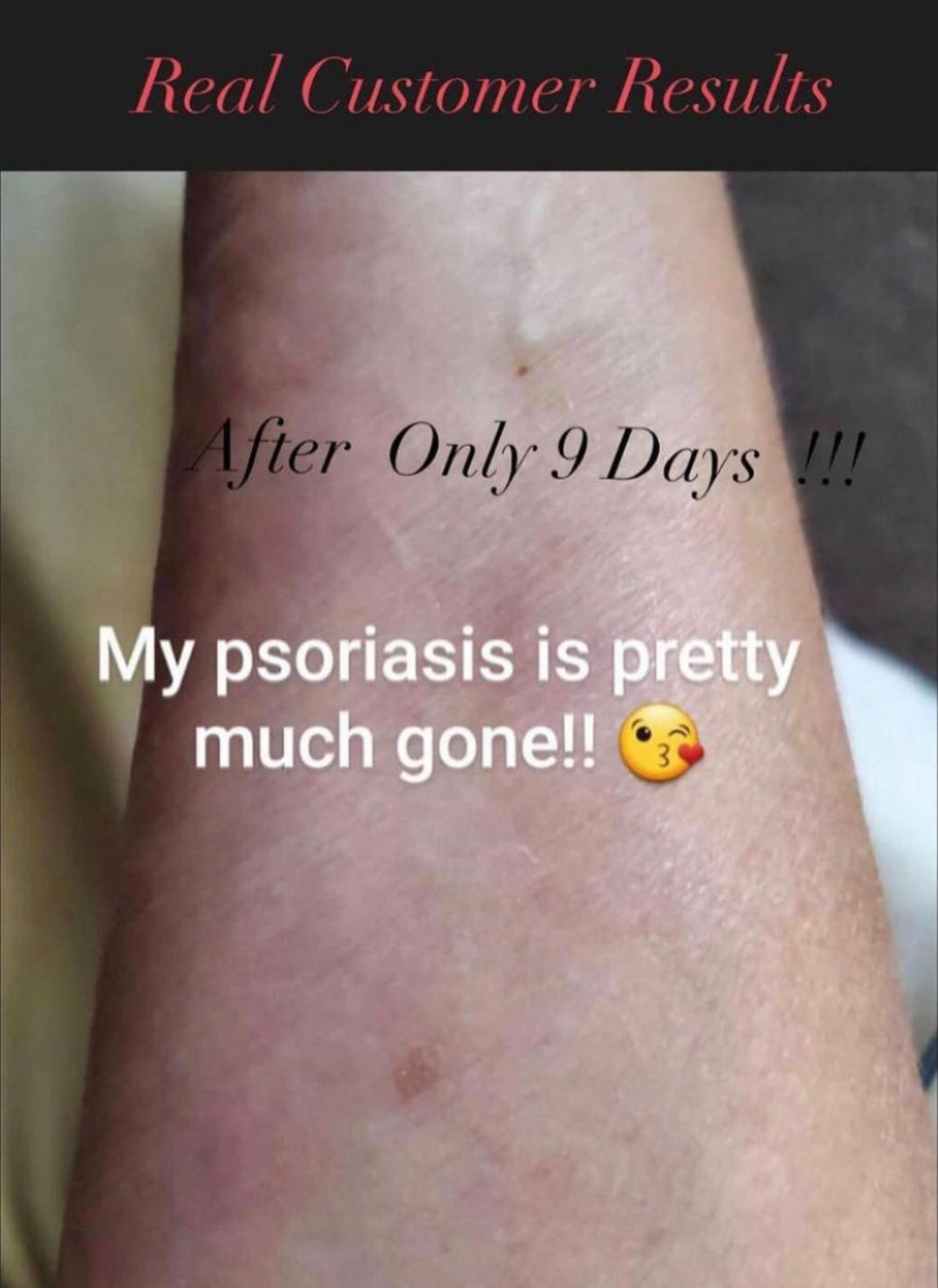 Prism Cream Psoriasis Cream Formulation Safe for All Skin Types Cooling ...