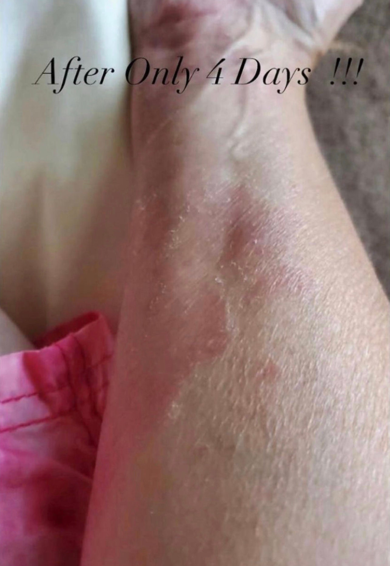 Prism Cream Psoriasis Cream Formulation Safe for All Skin Types Cooling ...