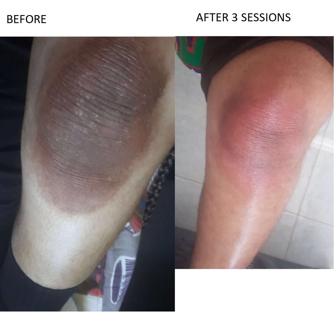 TCA 35% BUY1GET1FREE FREE SHIPPING Chemical Peel-exfoliate Dark ...