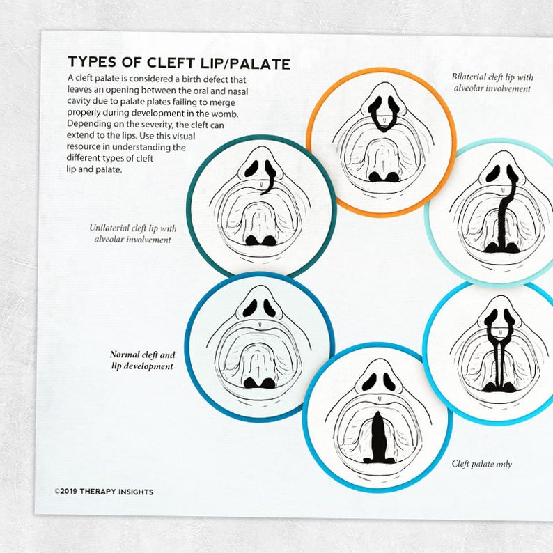 Types of Cleft Lip/palate - Etsy
