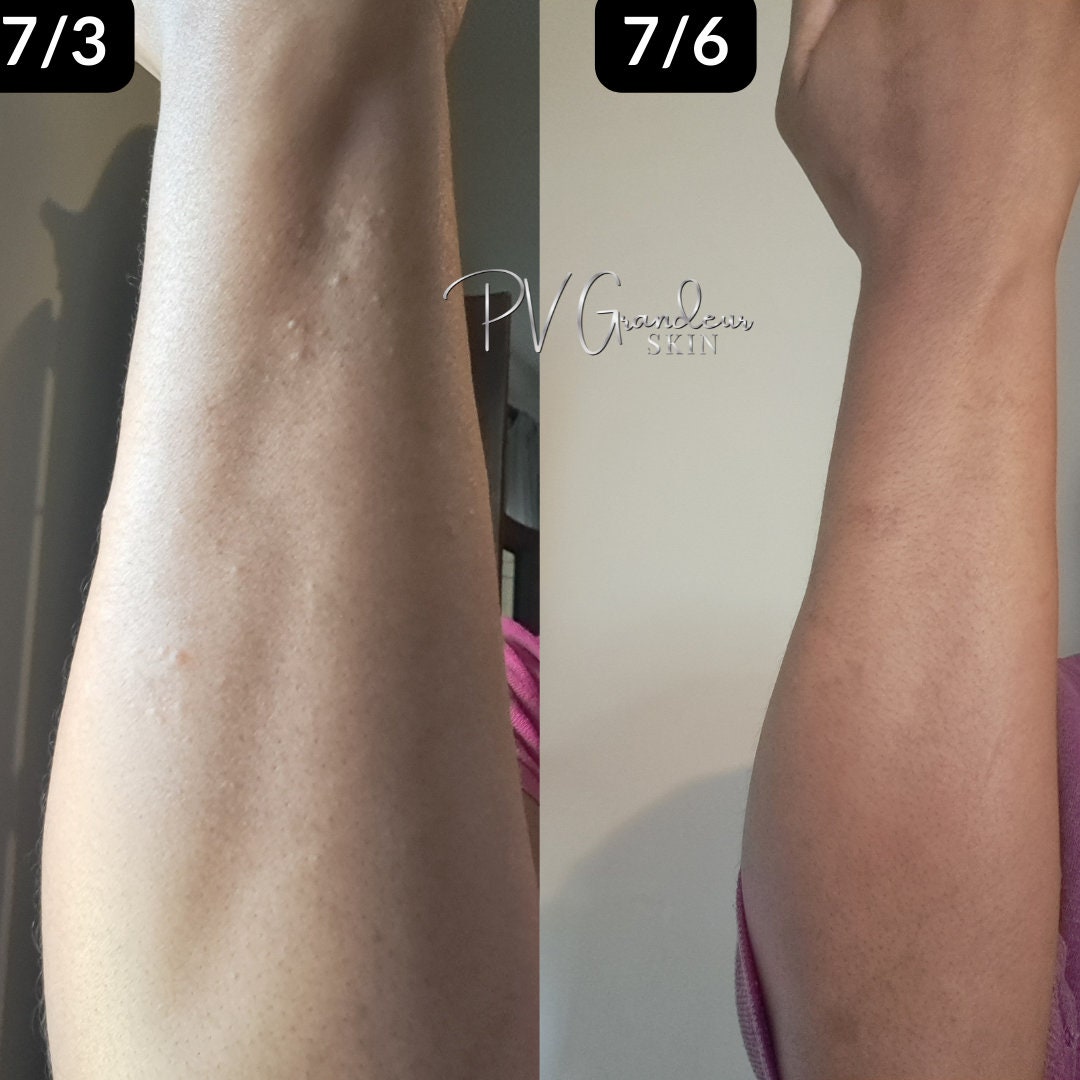 Eczema Gel| Dry Skin | Sensitive Skin| Organic Skincare| Healing Gel ...