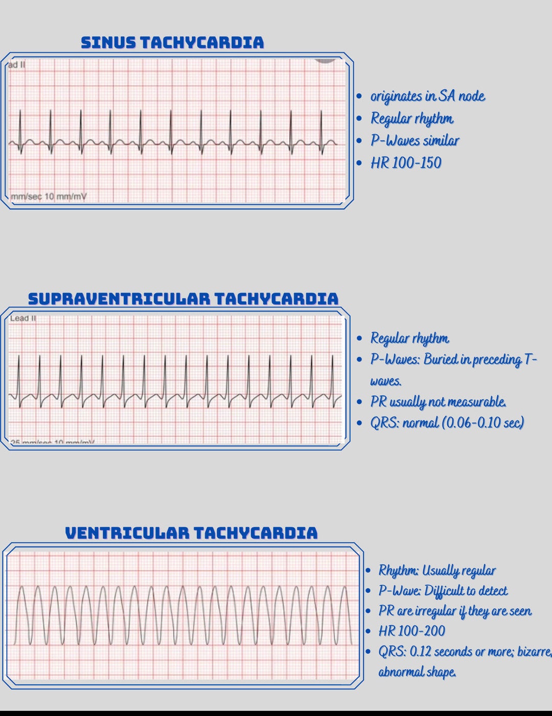 Taquicardia EKG ritmo Tiras - Etsy México