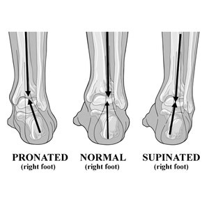 Medium 112mm Heel Angle Correction Gel Soft Silicone for Inward or ...