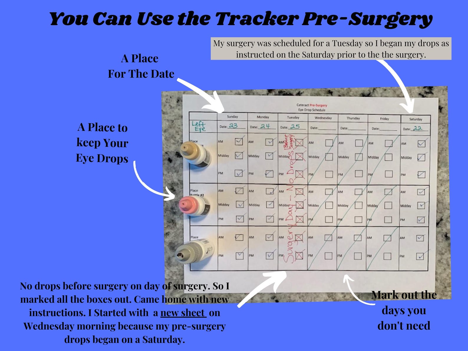 Eyedrop Cataract Surgery Eye Drop Tracker Eye Drop Schedule for ...