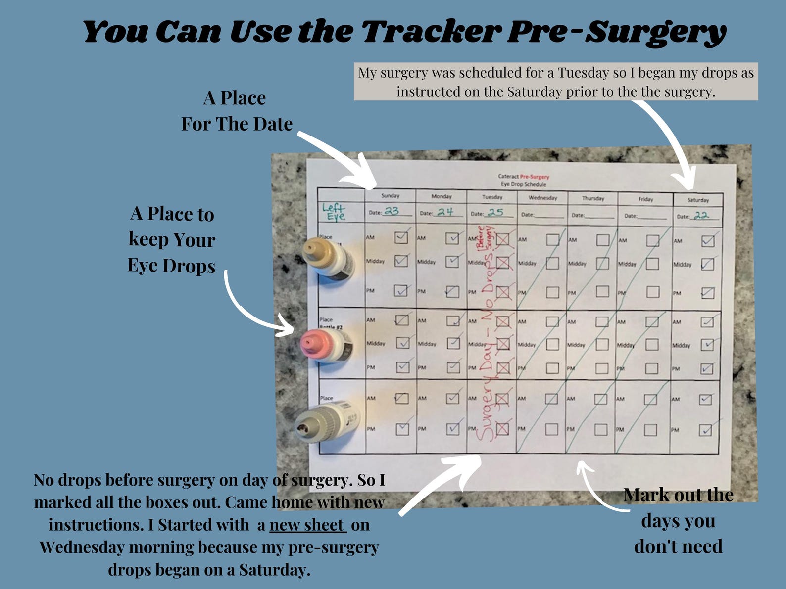 Cataract Eye Drop Schedule for Cataract Surgery Medication Tracker Eye ...