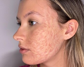 Burn Scar Prosthetic, SFX Makeup, Silicone Appliance, Halloween ...