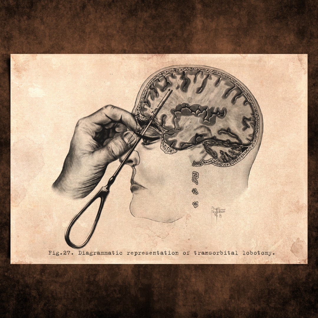 Lobotomy Diagram, Vintage Illustration, Art Print - A4 and A3 Size - Etsy