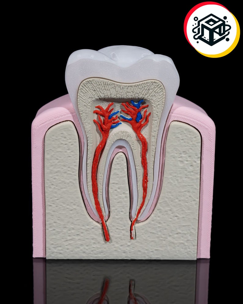 Molar and Dental Implant Cross-section Model - Etsy