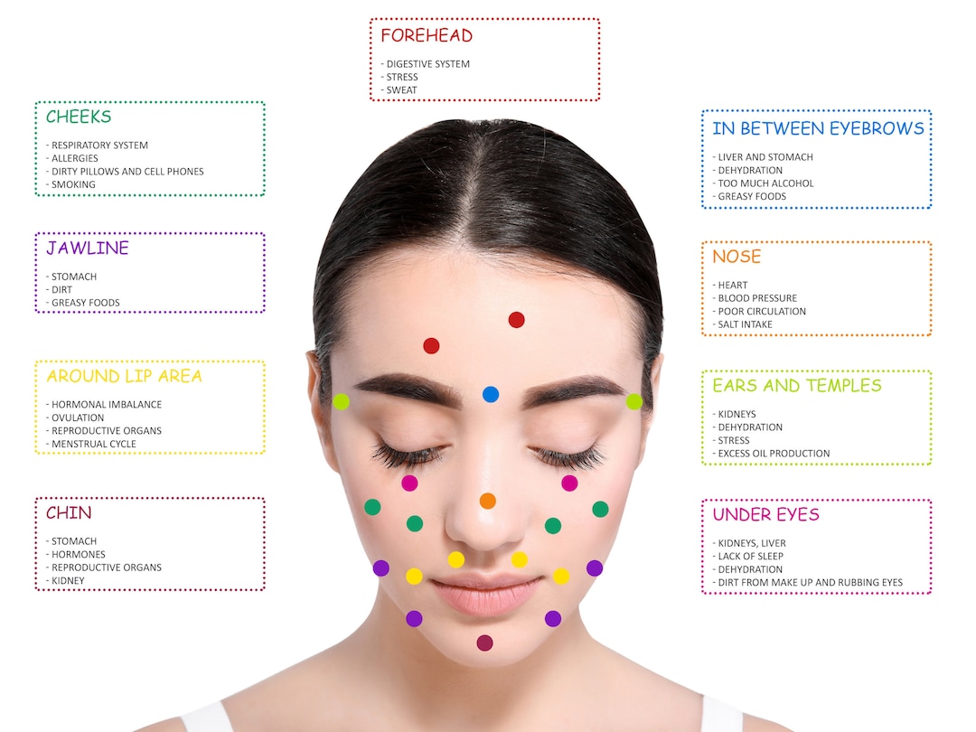 Acne Face Map Detailed Poster- Size 24x18 - Etsy