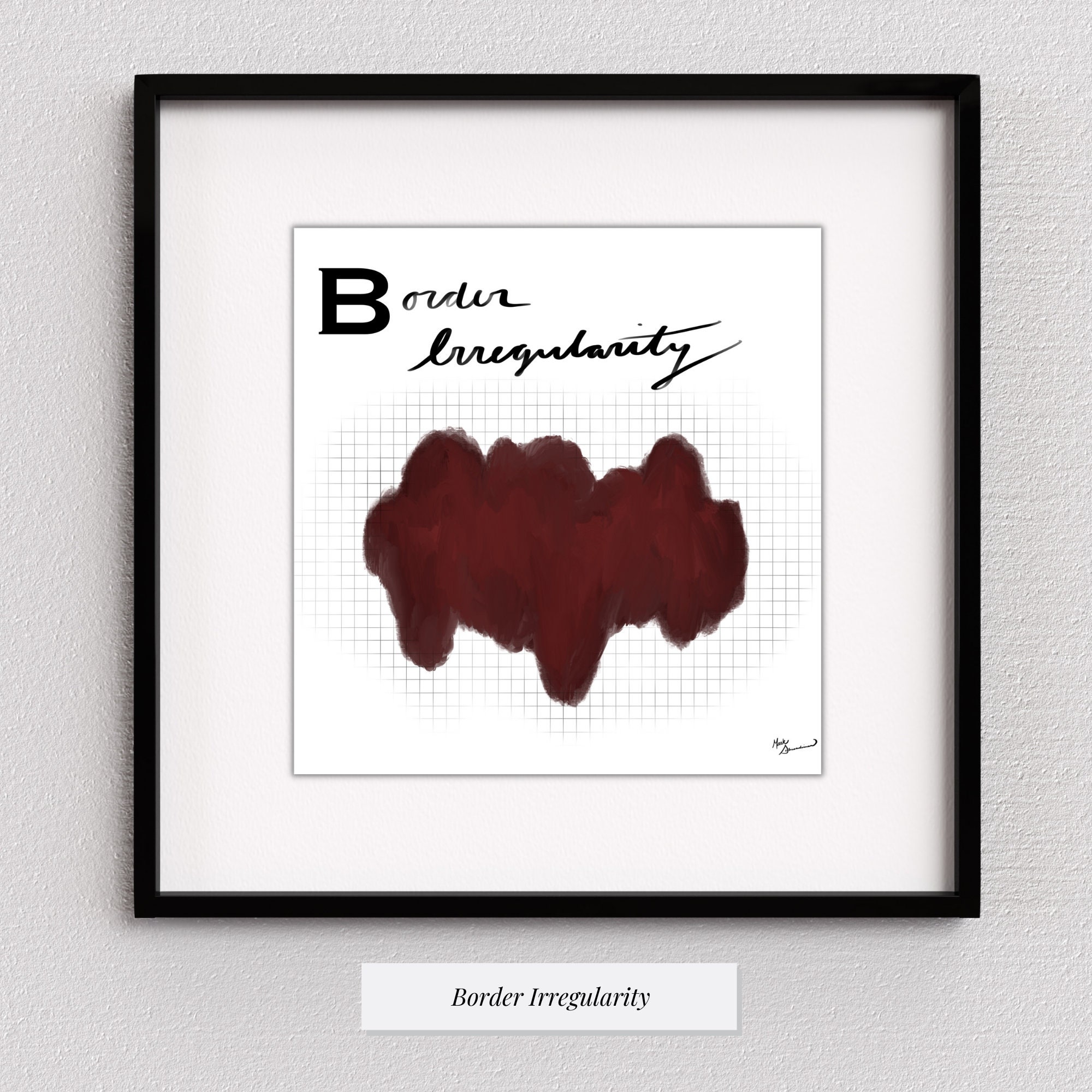 Melanoma Abcdes Art for Office, Dermatology, Skin Cancer Awareness - Etsy